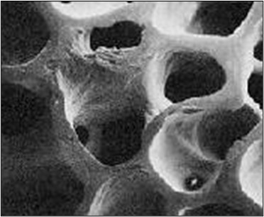 No Bones About It! Bone Diseases and Who They Can Affect (Part 2 of 6 ...