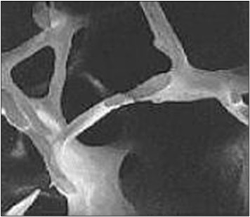 No Bones About It! Bone Diseases and Who They Can Affect (Part 2 of 6 ...